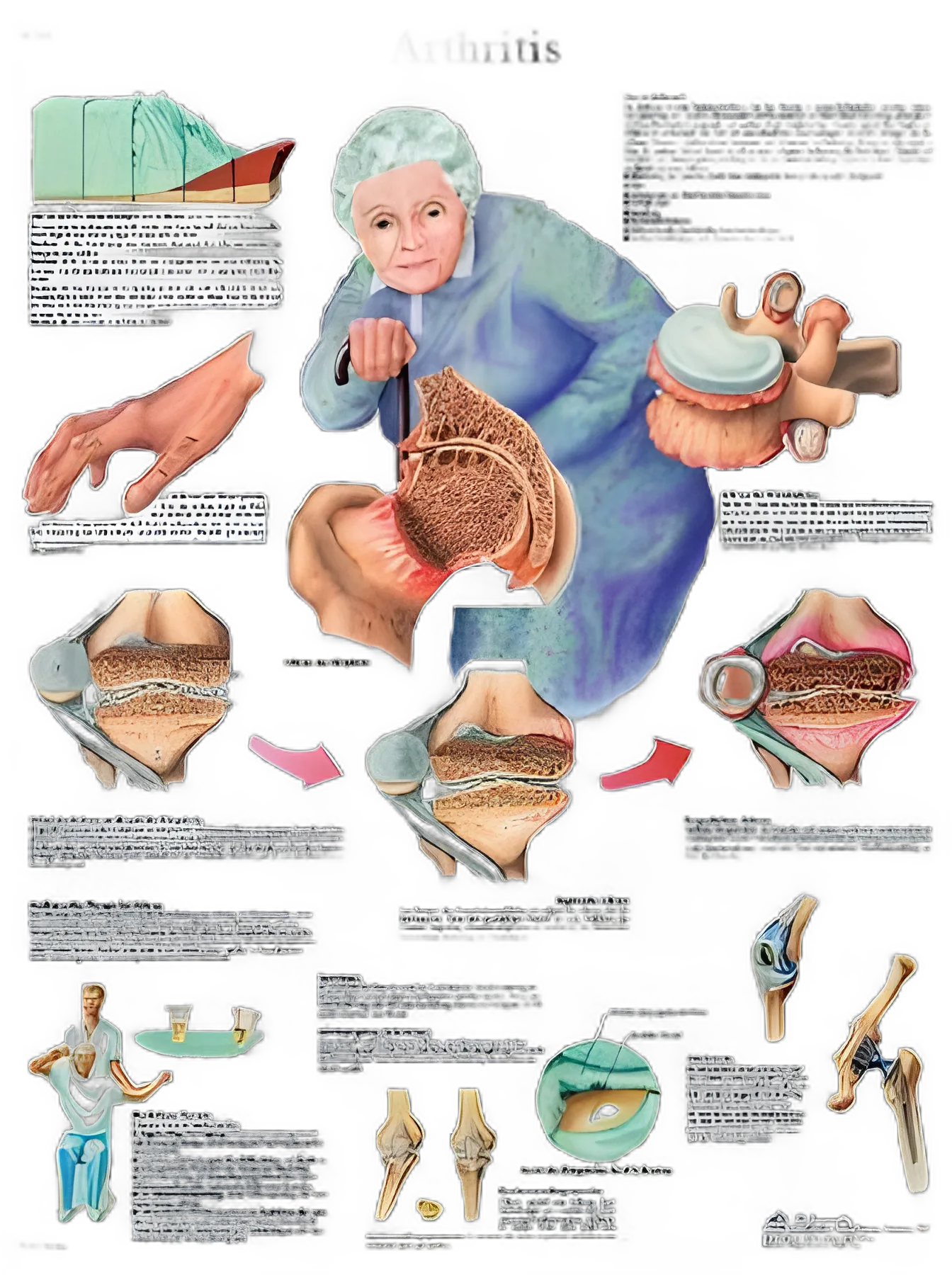 Arthritis Anatomical Chart 20x26 inch, Laminated - Educational Poster ...